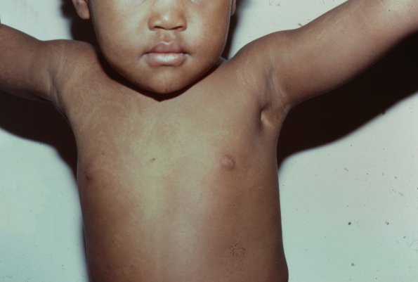 PICT0001 | Incontinentia Pigmenti | Dr. Ken Hashimoto | Wayne State University SOM - Dermatology ...